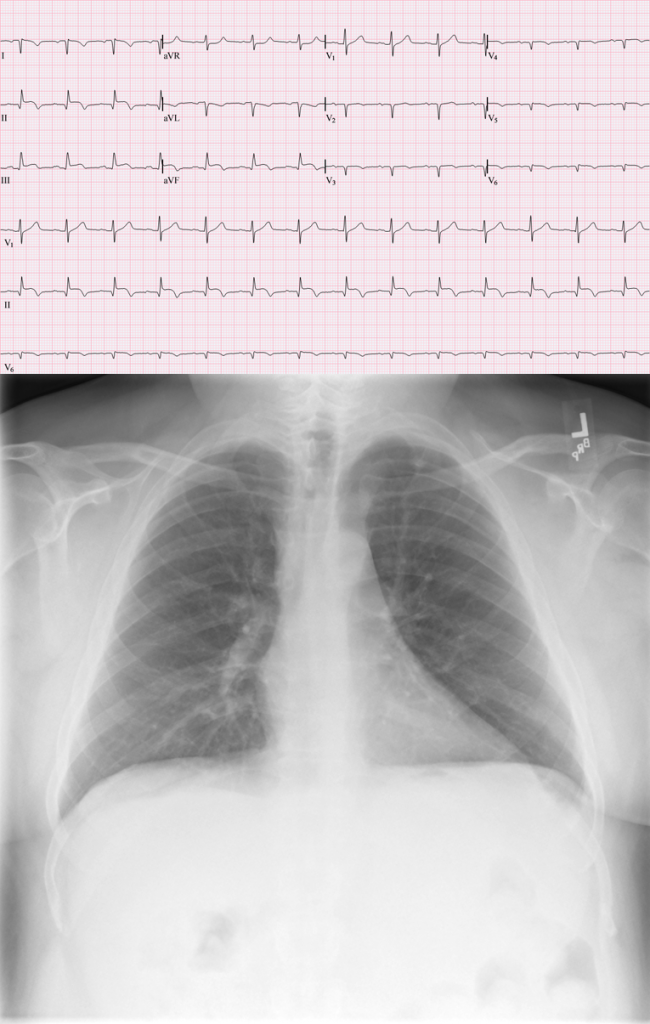 Right-sided series | ECG Guru - Instructor Resources Right-sided series | ECG Guru - Instructor Resources
